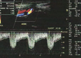 Carotid Ultrasound Los Angeles | Carotid Artery Test Beverly Hills