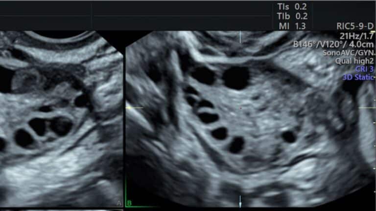 Comparing PCOS Ultrasound vs Normal Ultrasound: 3 Differences